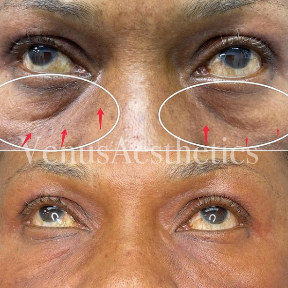 Botox Vs Filler Treatments Venus Aesthetics Anti Aging